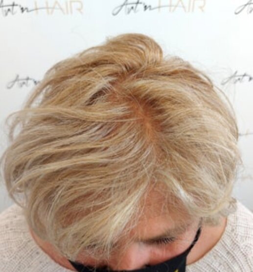 Greffe de cheveux et Implants Capillaires Avant Après | Smile Partner