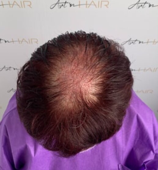 Greffe de cheveux et Implants Capillaires Avant Après | Smile Partner