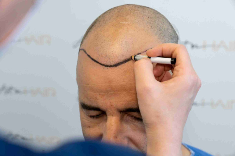 Greffe de cheveux : quel résultat après 6 mois ? - Smile Partner