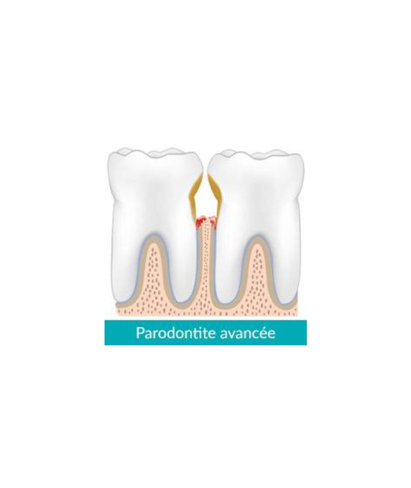 ᐅ Parodontite : qu'est-ce que c'est et comment la soigner