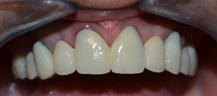 Couronne zircone : la solution esthétique n°1 pour vos dents