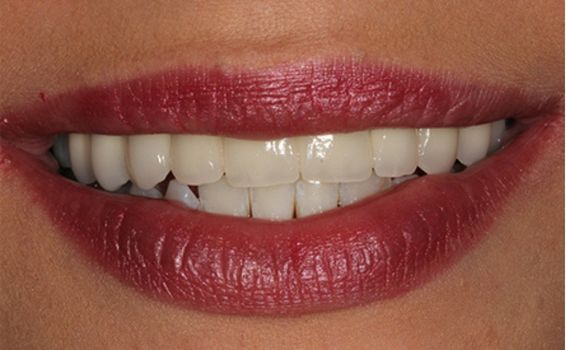 Couronne dentaire en zircone : monolithique ou finition céramique