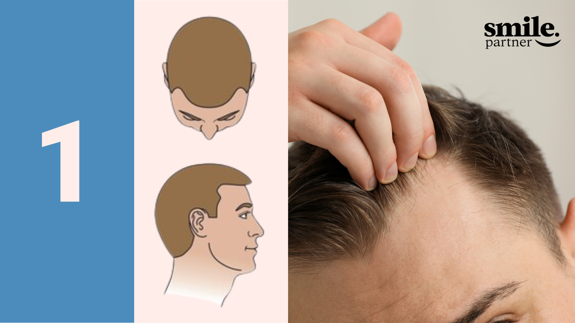 Les 7 stades de la calvitie chez l'homme