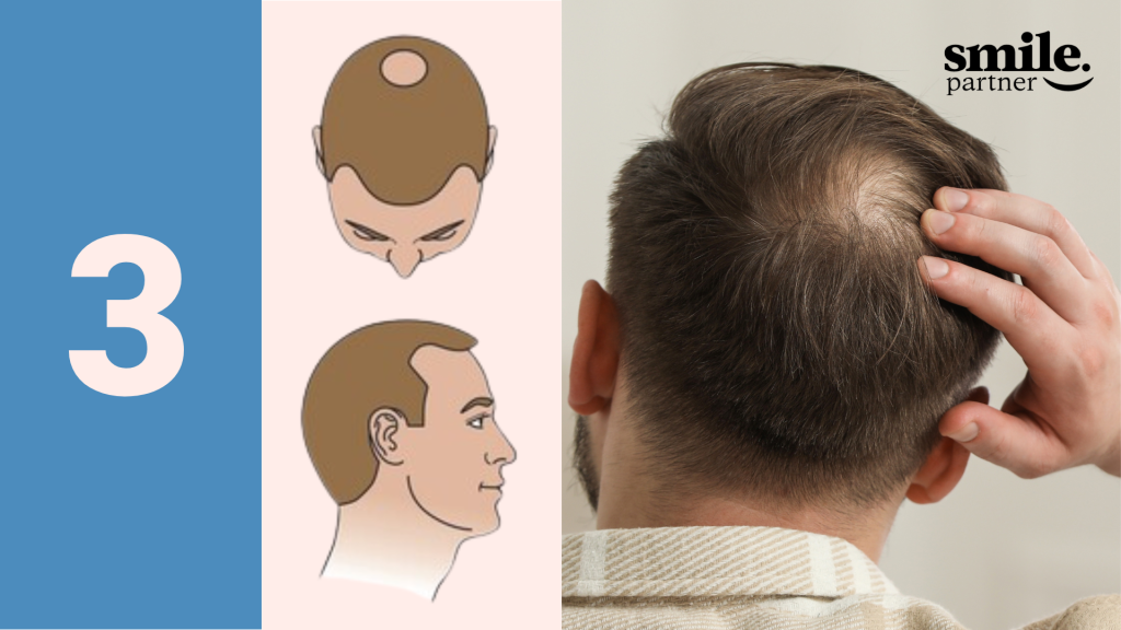 Les 7 stades de la calvitie chez l'homme