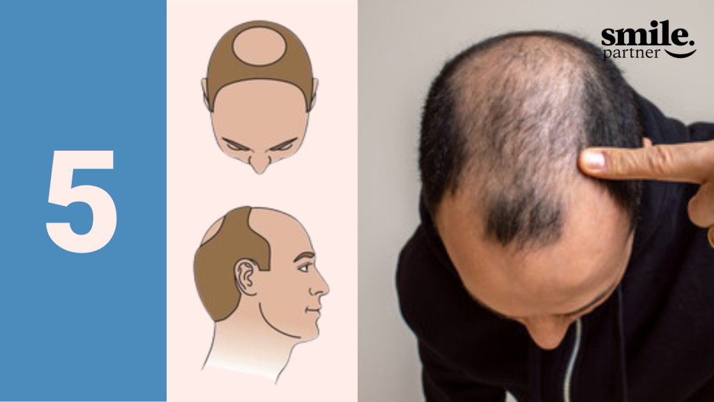 Les 7 stades de la calvitie chez l'homme