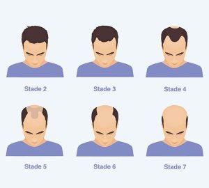 Quand faire une greffe de cheveux : 3 critères à considérer