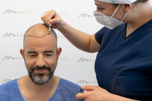 Greffe de cheveux « pas cher » : les pièges à éviter