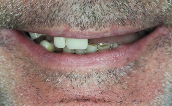 Prothèse dentaire fixe ou amovible : Quelle est la meilleure option