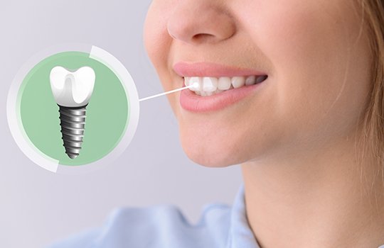 Les Meilleures Marques d'Implants Dentaires : Guide et Comparatif 2026