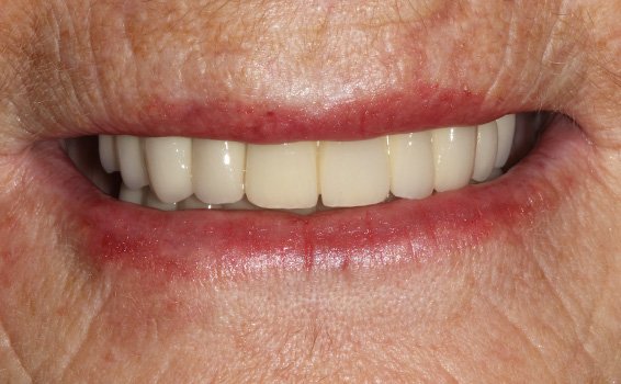 Prothèse dentaire fixe ou amovible : Quelle est la meilleure option