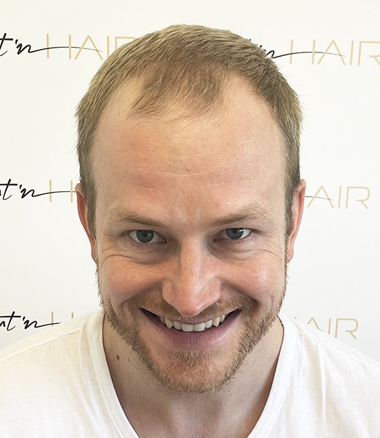 Prix d'une greffe de cheveux en 2025 : Décryptage des Tarifs