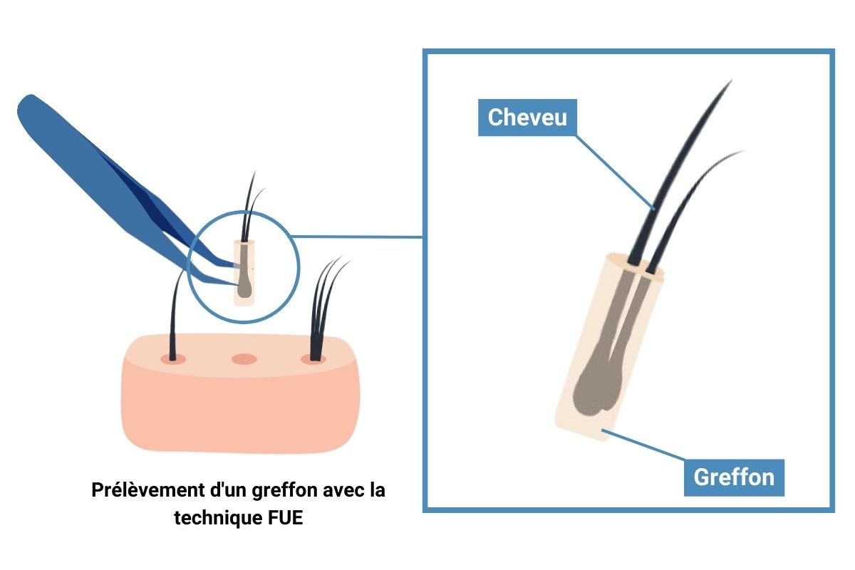 Implant Capillaire : le Guide pour Retrouver une Chevelure Dense