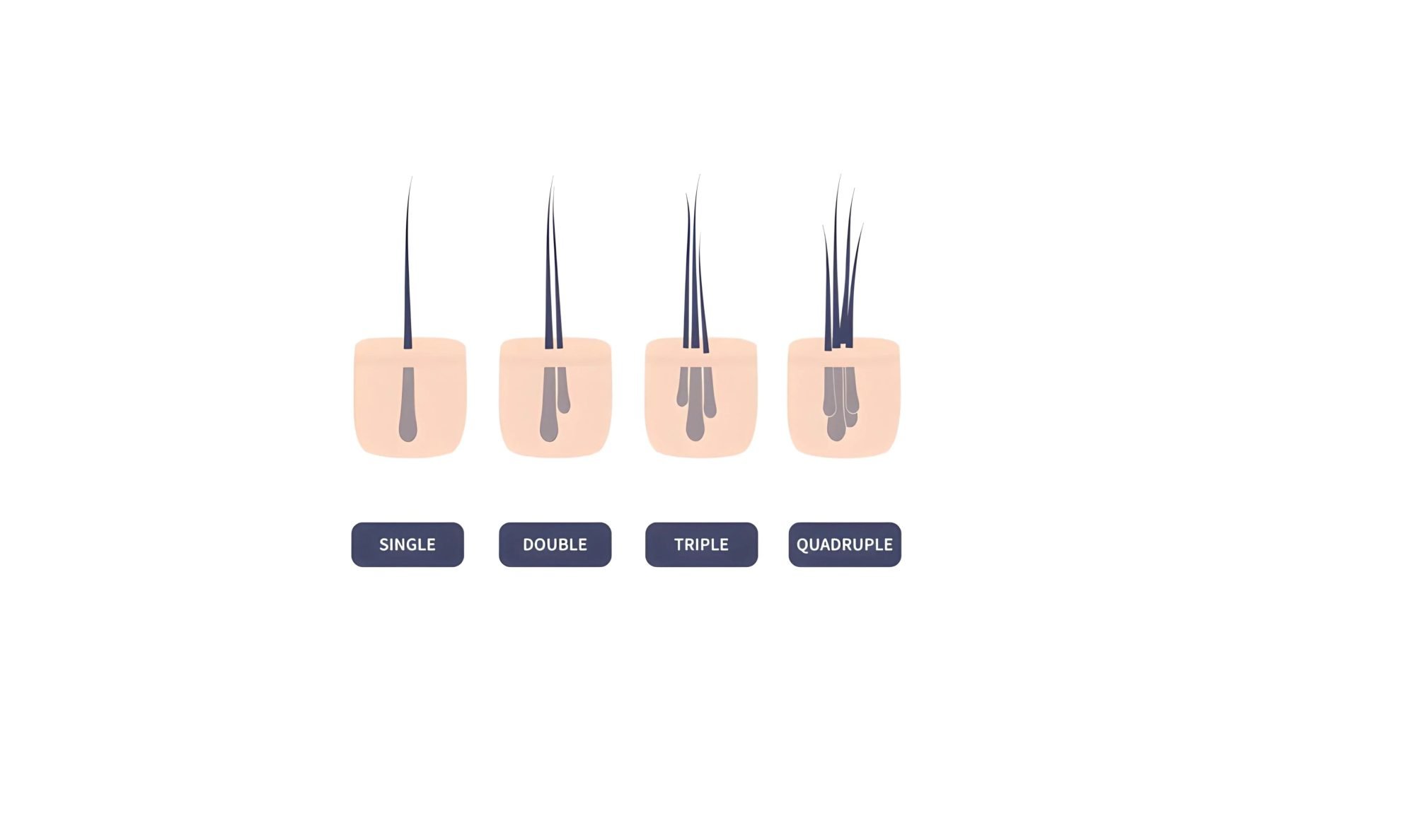 Qu'est ce qu'un greffon ? Comprendre la greffe de cheveux