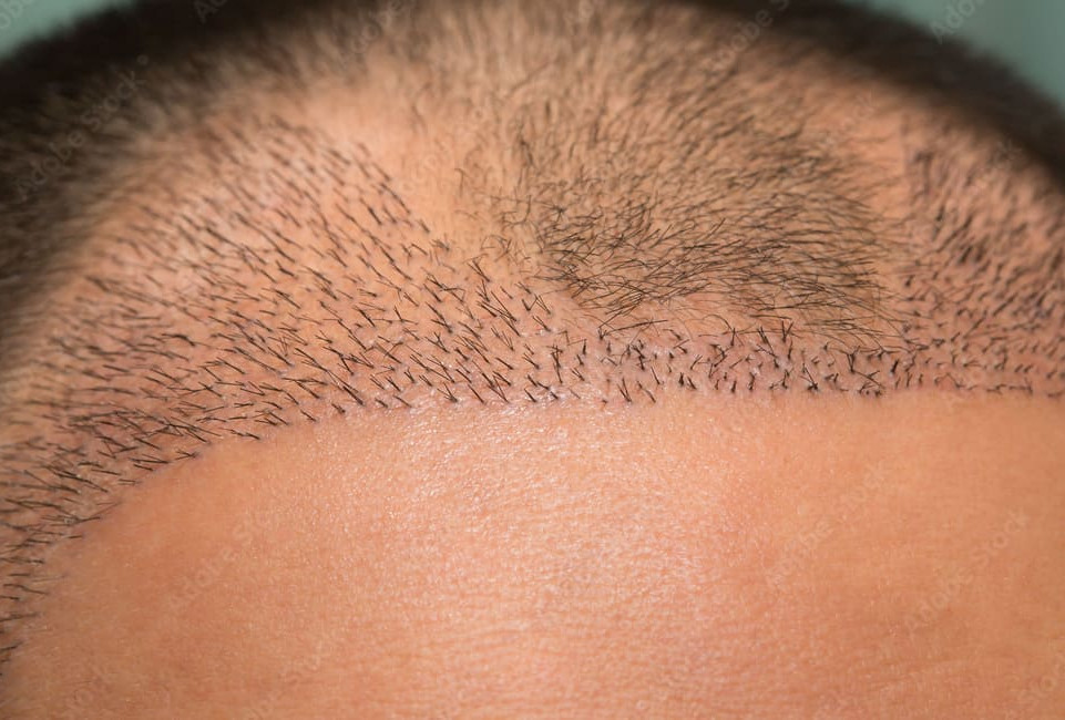 Qu'est ce qu'un greffon ? Décryptage pour comprendre facilement