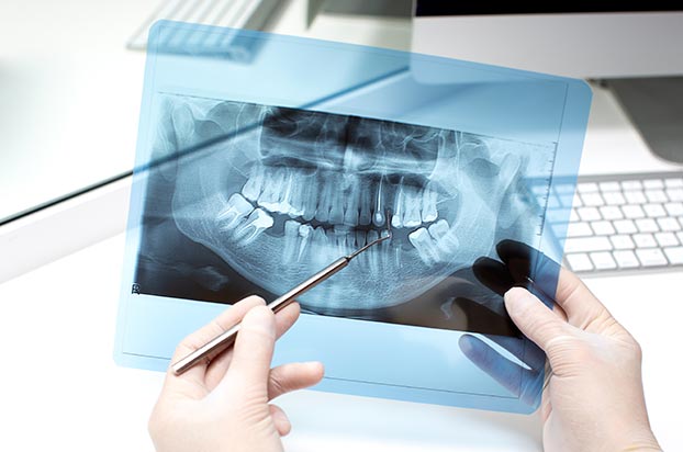 Pose d'un implant dentaire : 3 étapes pour comprendre facilement