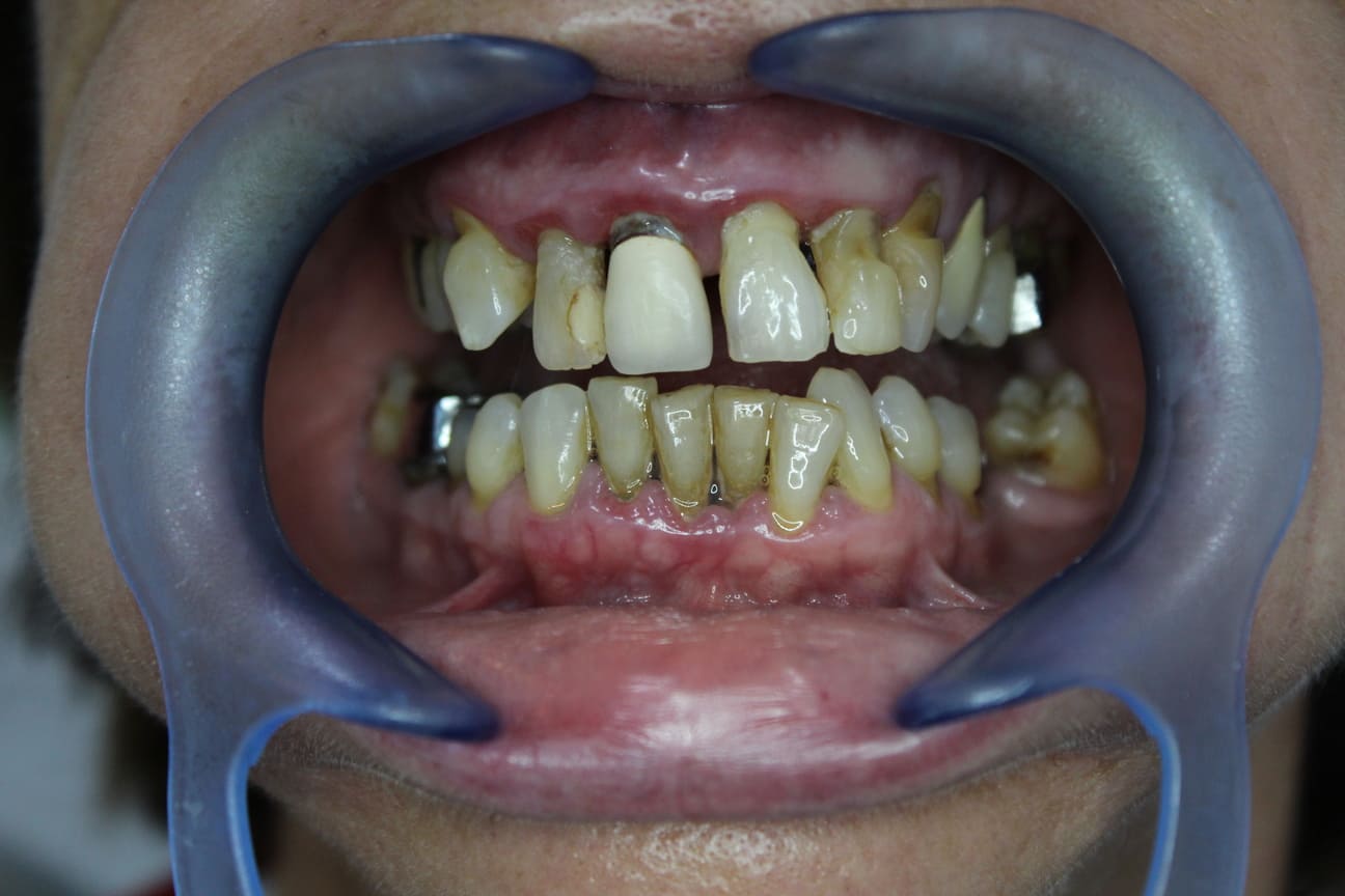 Déchaussement des dents : c’est quoi ? Définition simple