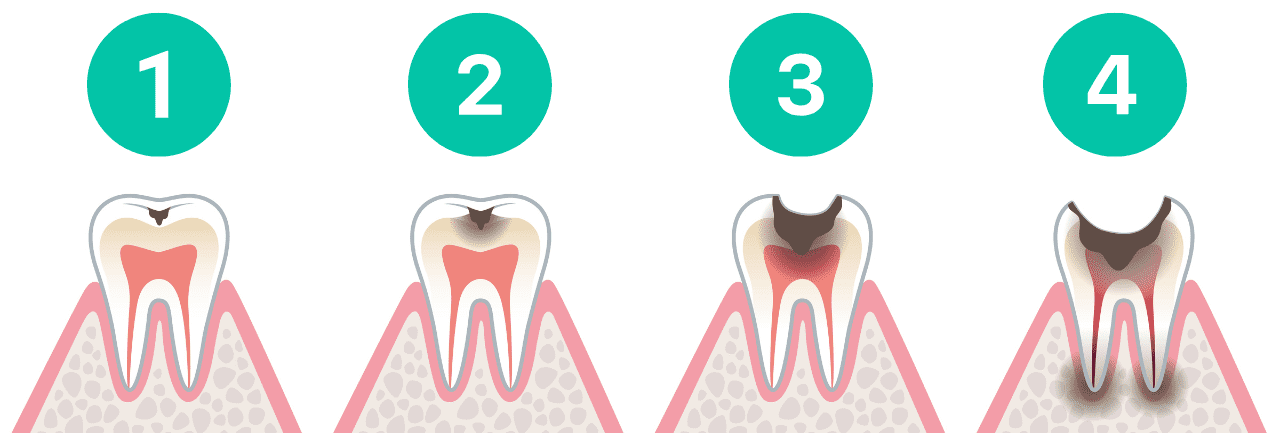 Éviter la Carie Dentaire : Causes et Solutions efficaces