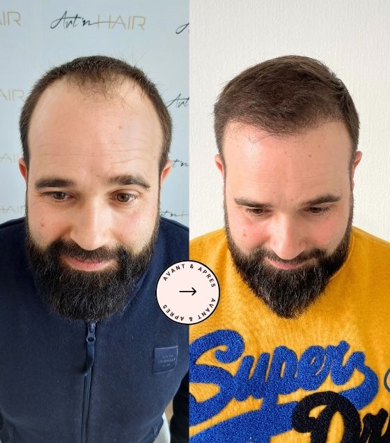 Vertex, calvitie et greffe de cheveux : conseils d'experts
