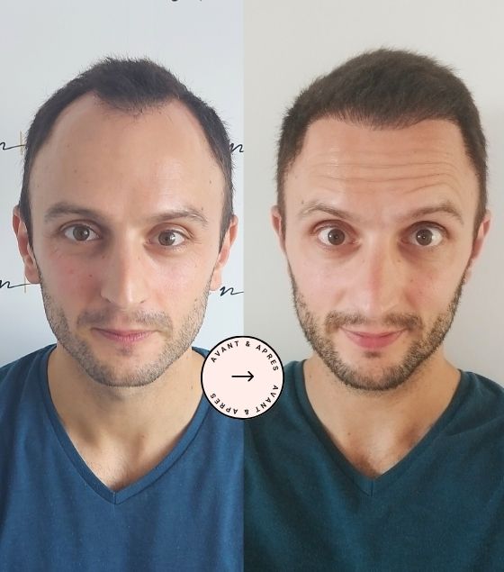 Implants capillaires : dites adieu à la calvitie