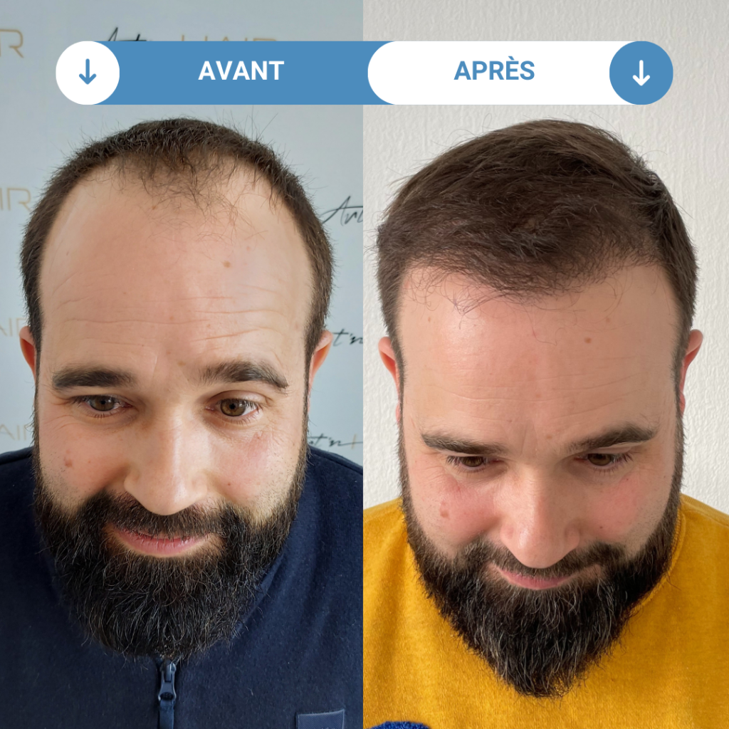 Implant Capillaire : le Guide pour Retrouver une Chevelure Dense