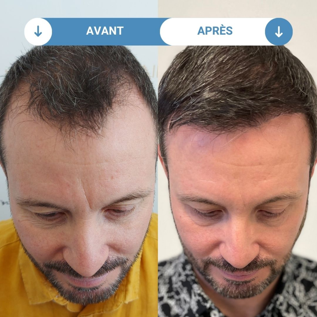 Implant Capillaire : le Guide pour Retrouver une Chevelure Dense