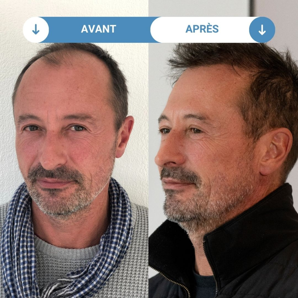 Implant Capillaire : le Guide pour Retrouver une Chevelure Dense