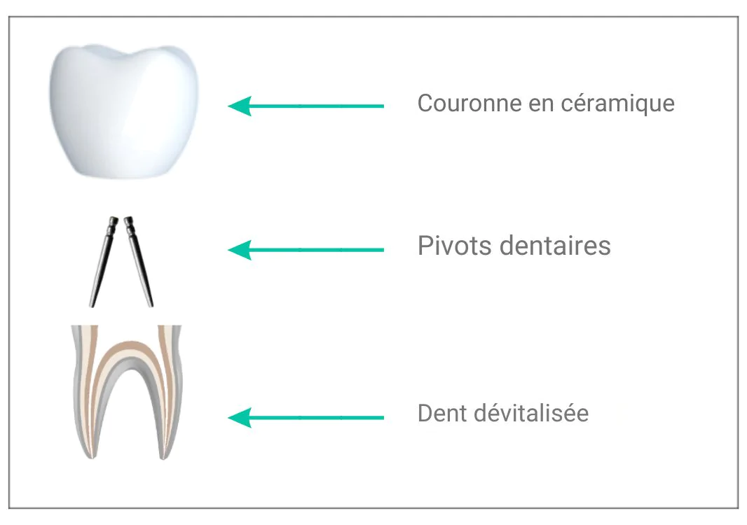 Implant dentaire ou dent sur pivot : Comment les différencier
