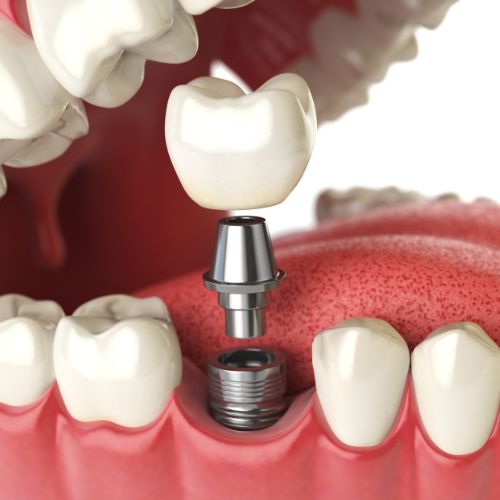 Pose d’une prothèse dentaire fixe : quelles sont les étapes