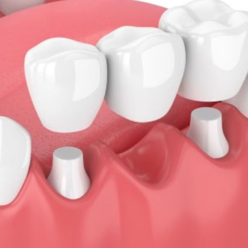 Pose d’une prothèse dentaire fixe : quelles sont les étapes