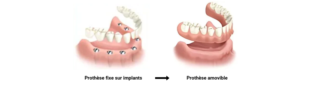 Prothèse dentaire fixe ou amovible : Quelle est la meilleure option