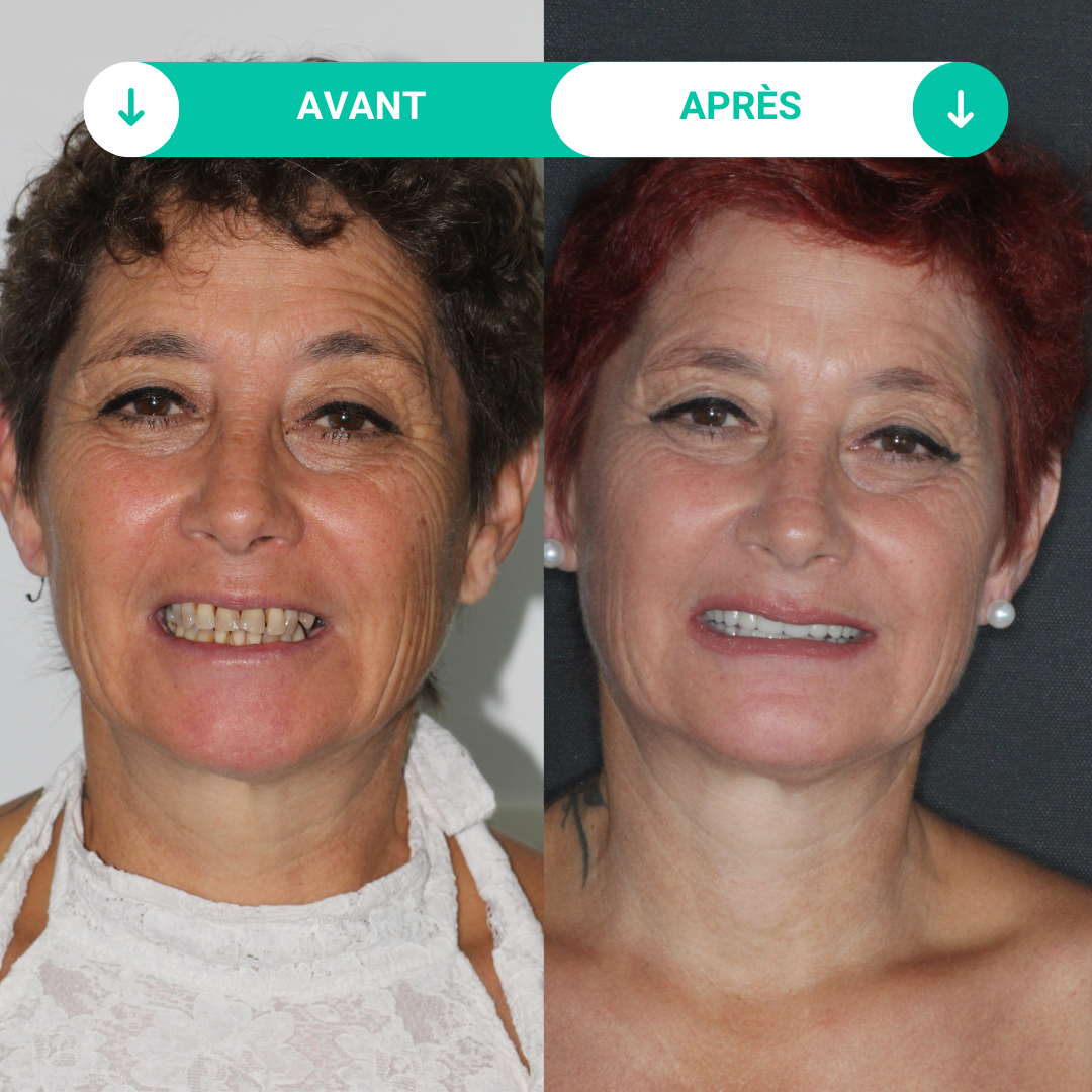 Dentier fixe : La solution de confort