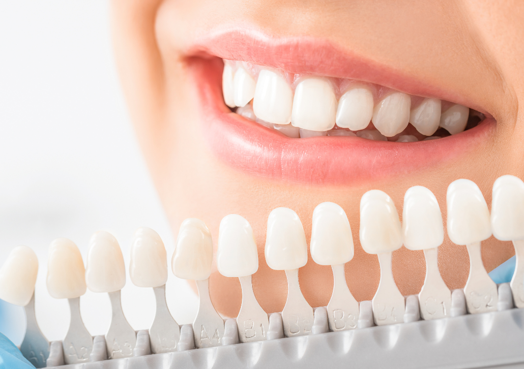 Couronne dentaire en zircone : monolithique ou finition céramique