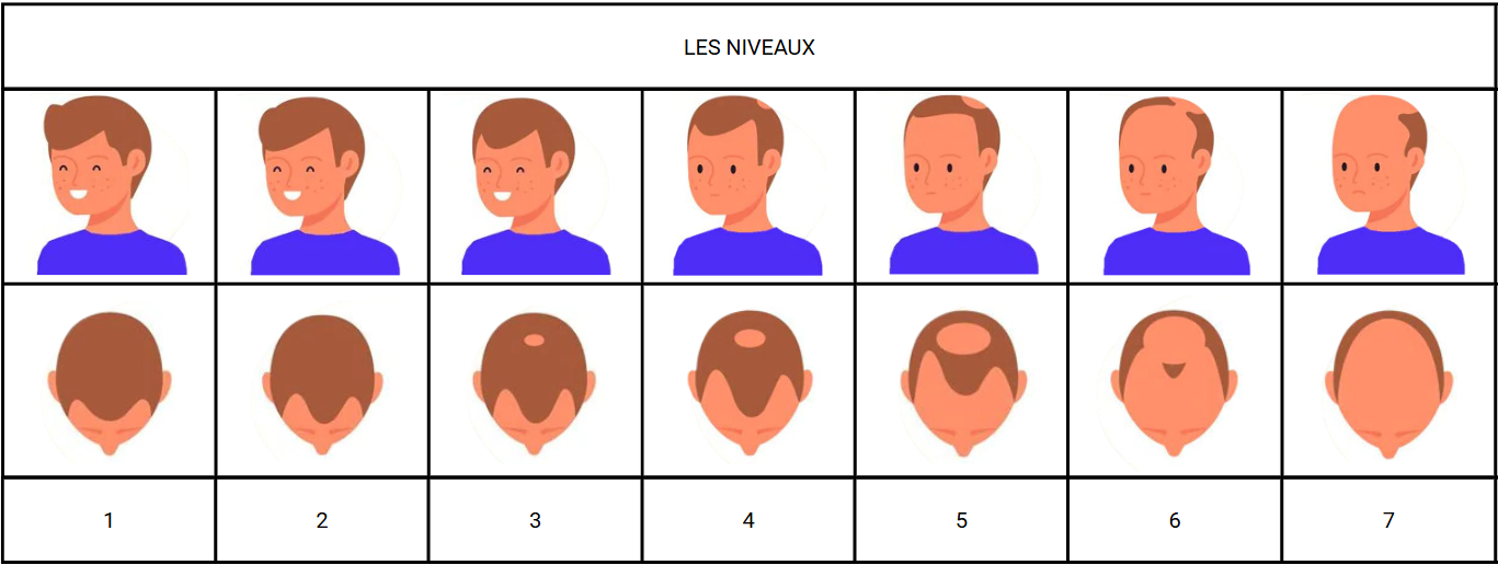 La calvitie chez l'homme : les premiers signes et solutions
