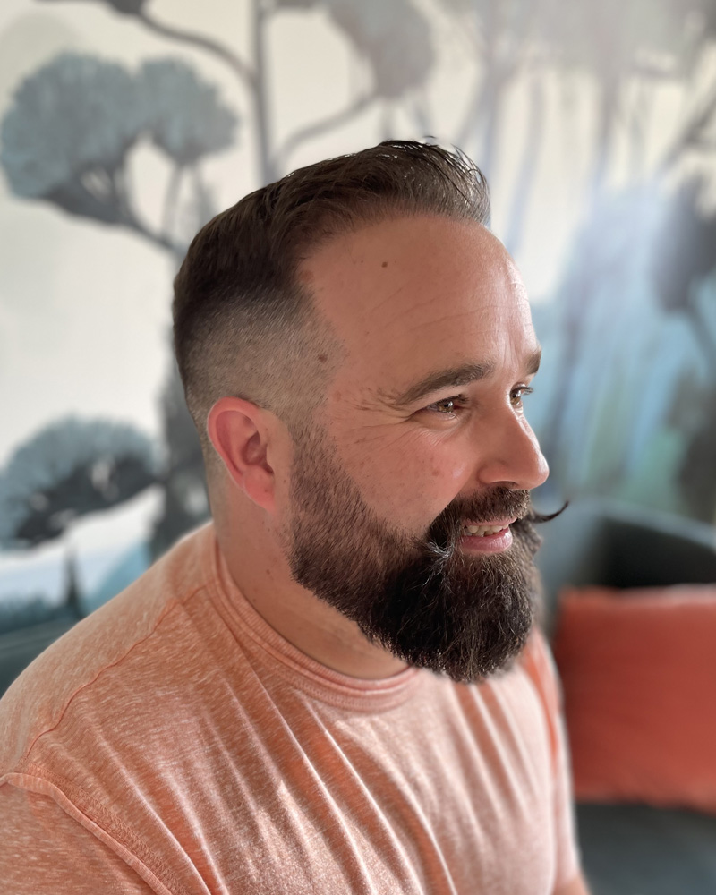 Avant / Après greffe de cheveux - David - Smile Partner