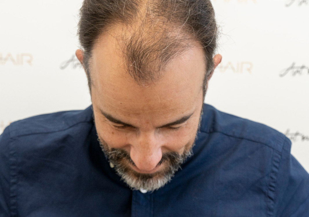Greffe de cheveux ligne frontale : techniques, résultats et conseils