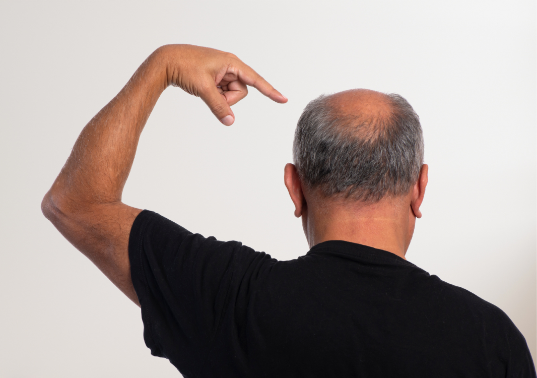Calvitie arrière du crâne : la tonsure et les solutions durables