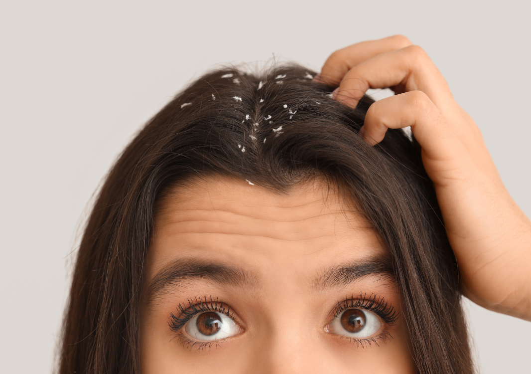 Dermatite séborrhéique et pellicules grasses : causes et solutions