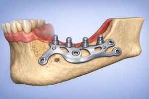 Implants juxta-osseux : la solution quand l’os est insuffisant (atrophie)